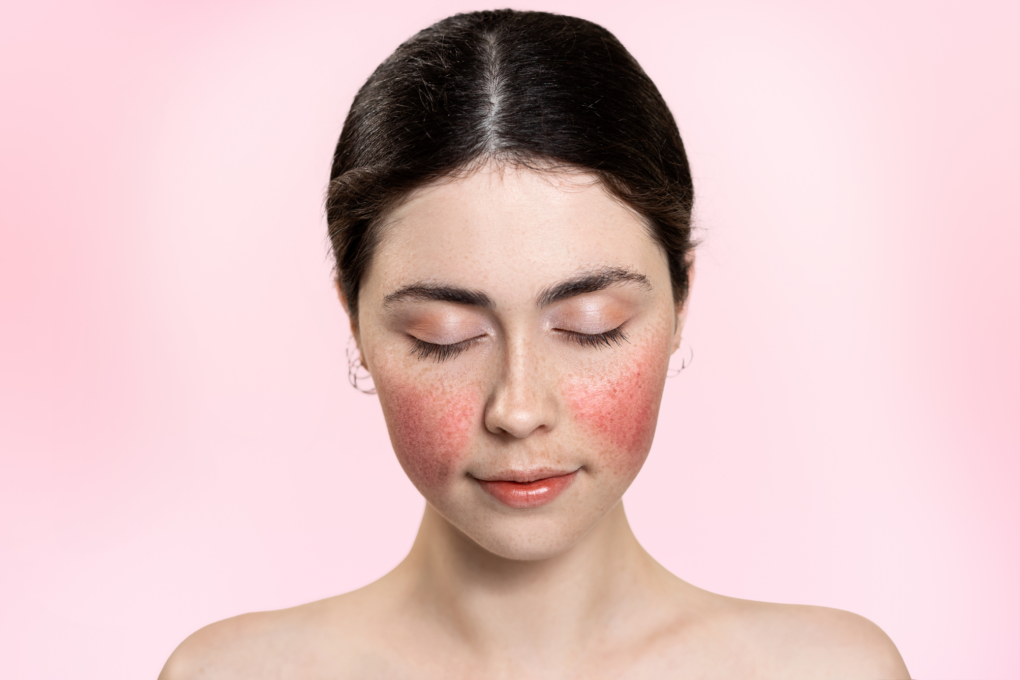 Unlocking the secrets of effective rosacea treatment